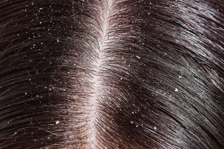 How to Get Rid of Waxy Buildup on Scalp and Hair - Foreign Policy